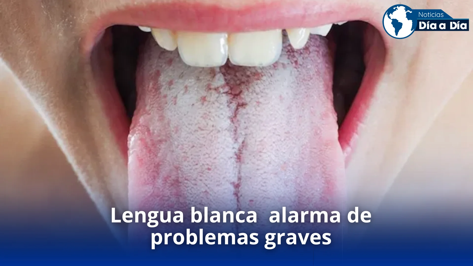 La Higiene Bucal Prevención de la Lengua Blanca - Noticias de hoy en ...